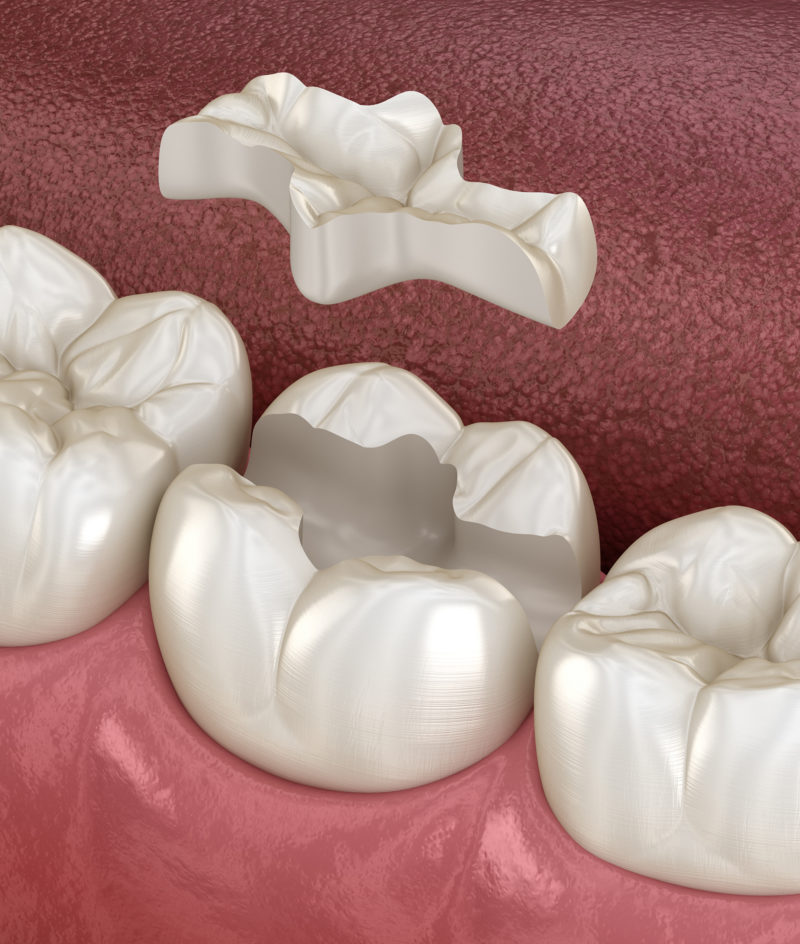 Inlays & Onlays: Aesthetic Solutions for Dental Cavities